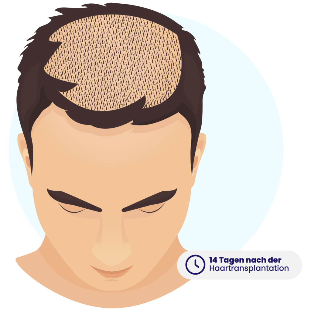 Dauer der Heilung - SwissMedHair
