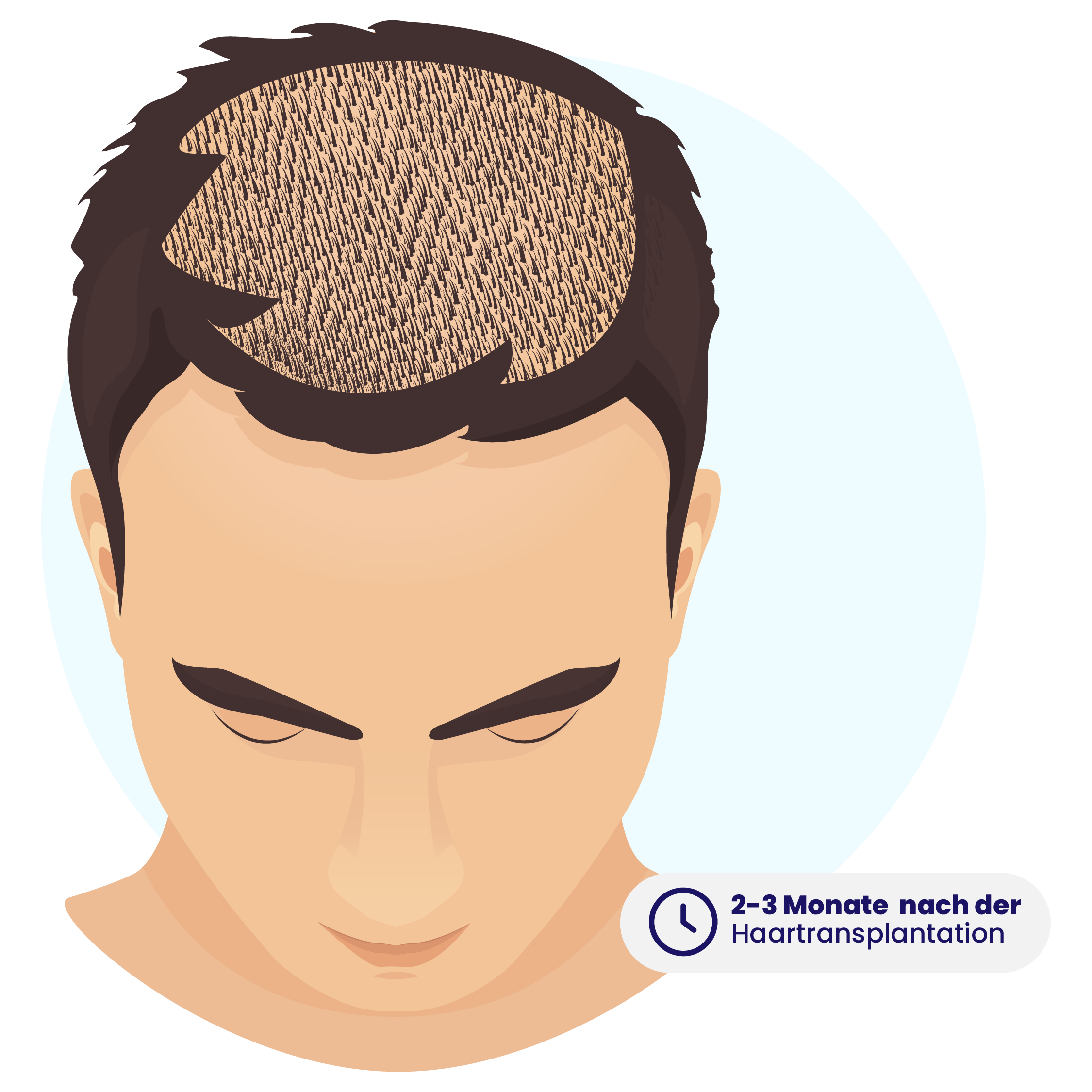 Dauer der Heilung - SwissMedHair