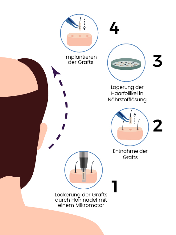 FUE Haartransplantation - SwissMedHair